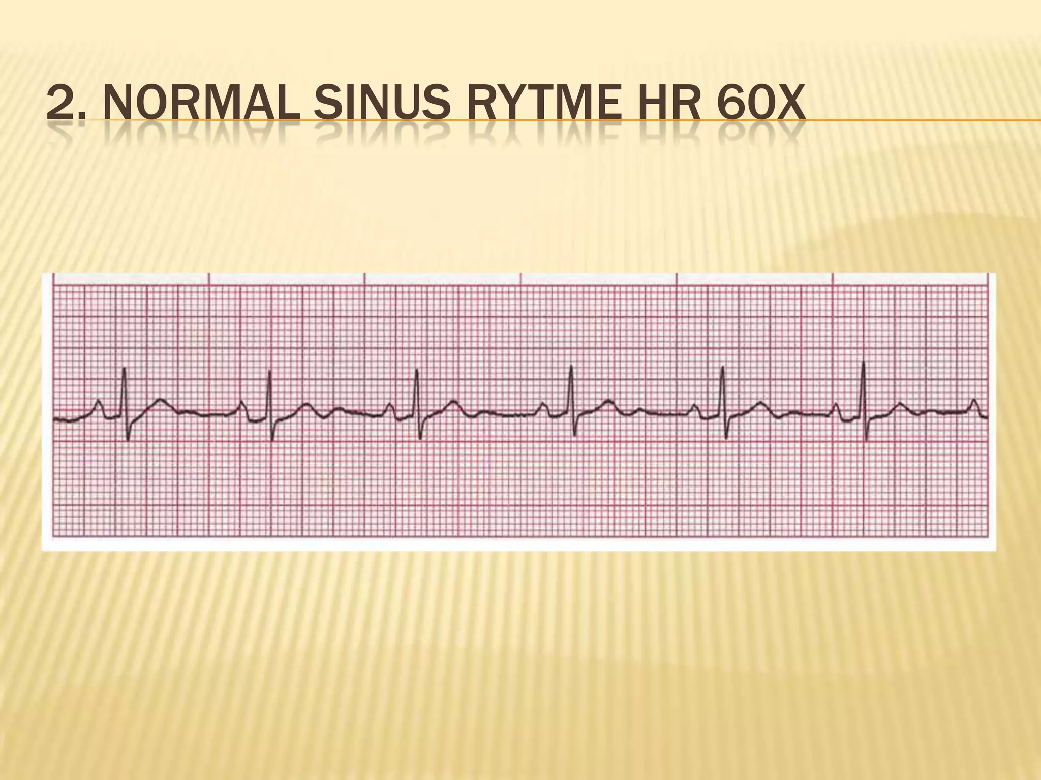 10 gambar ekg slide shere | PPTX
