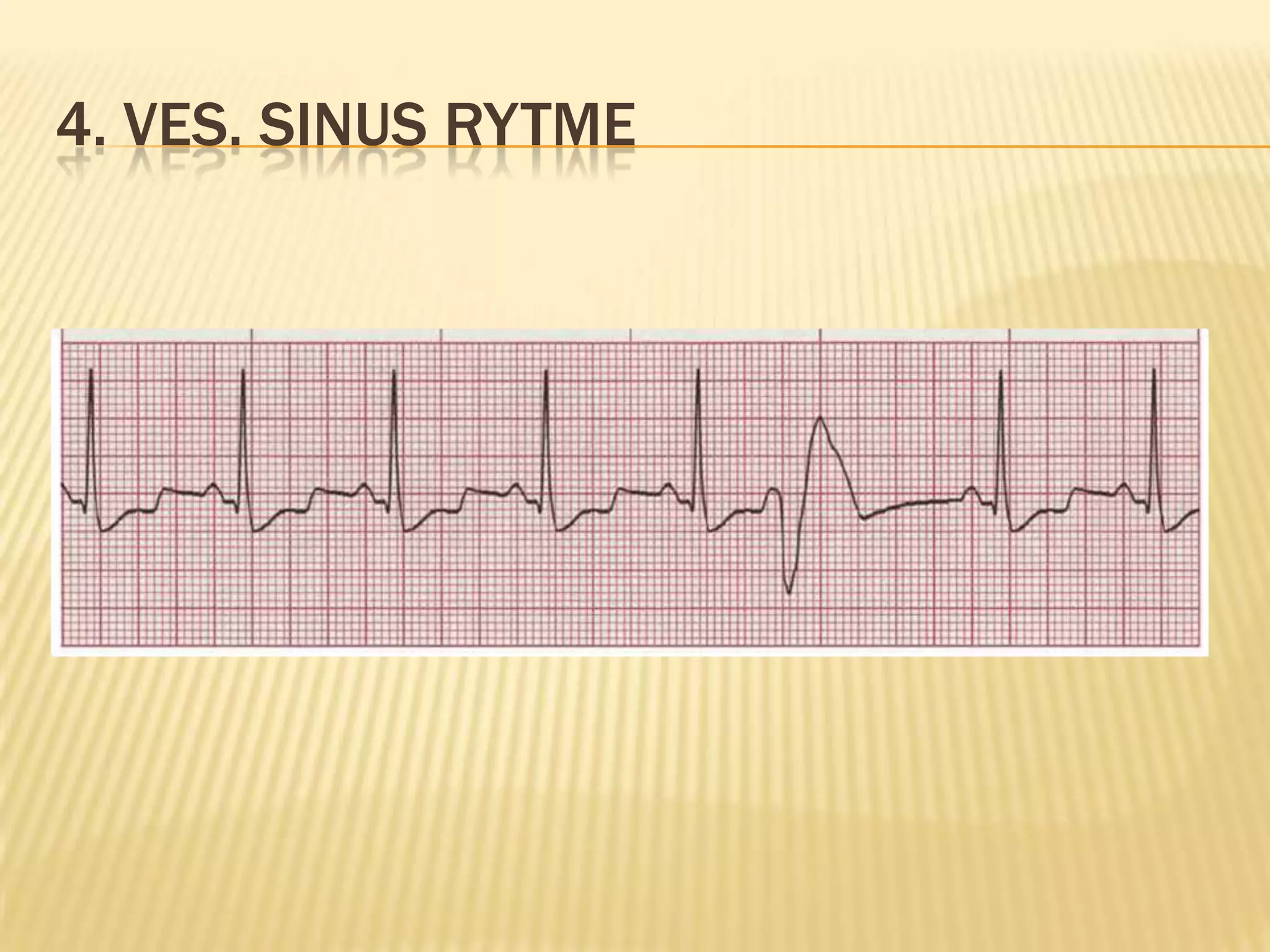 10 gambar ekg slide shere | PPTX