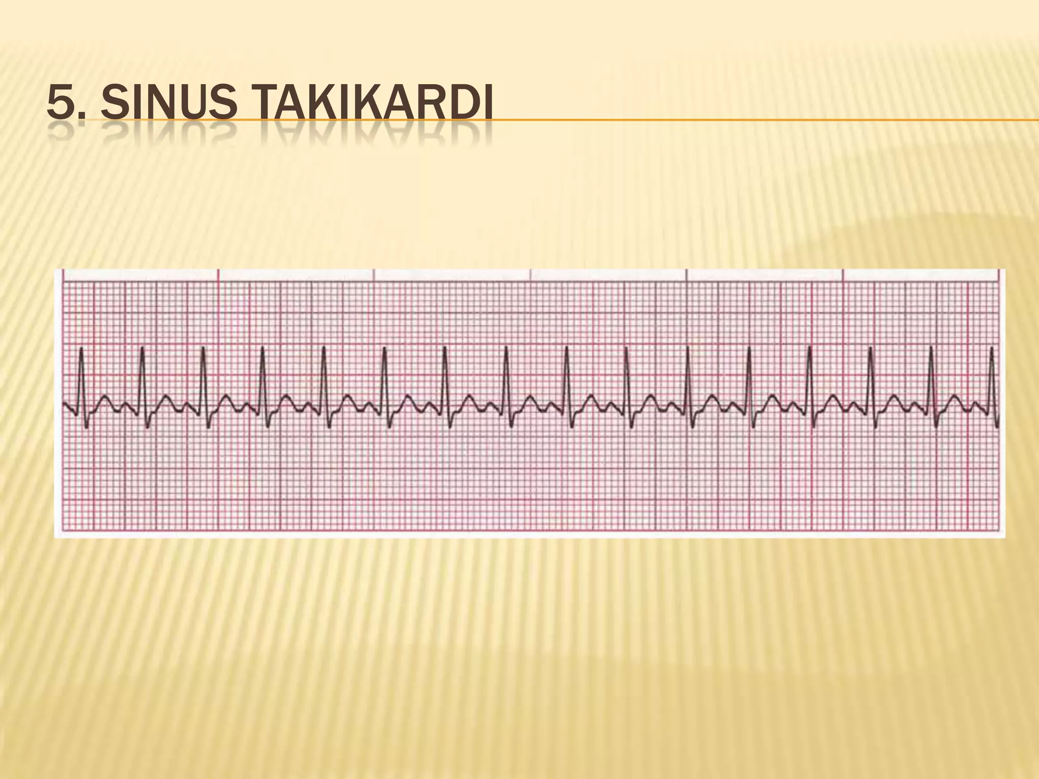 10 gambar ekg slide shere | PPTX