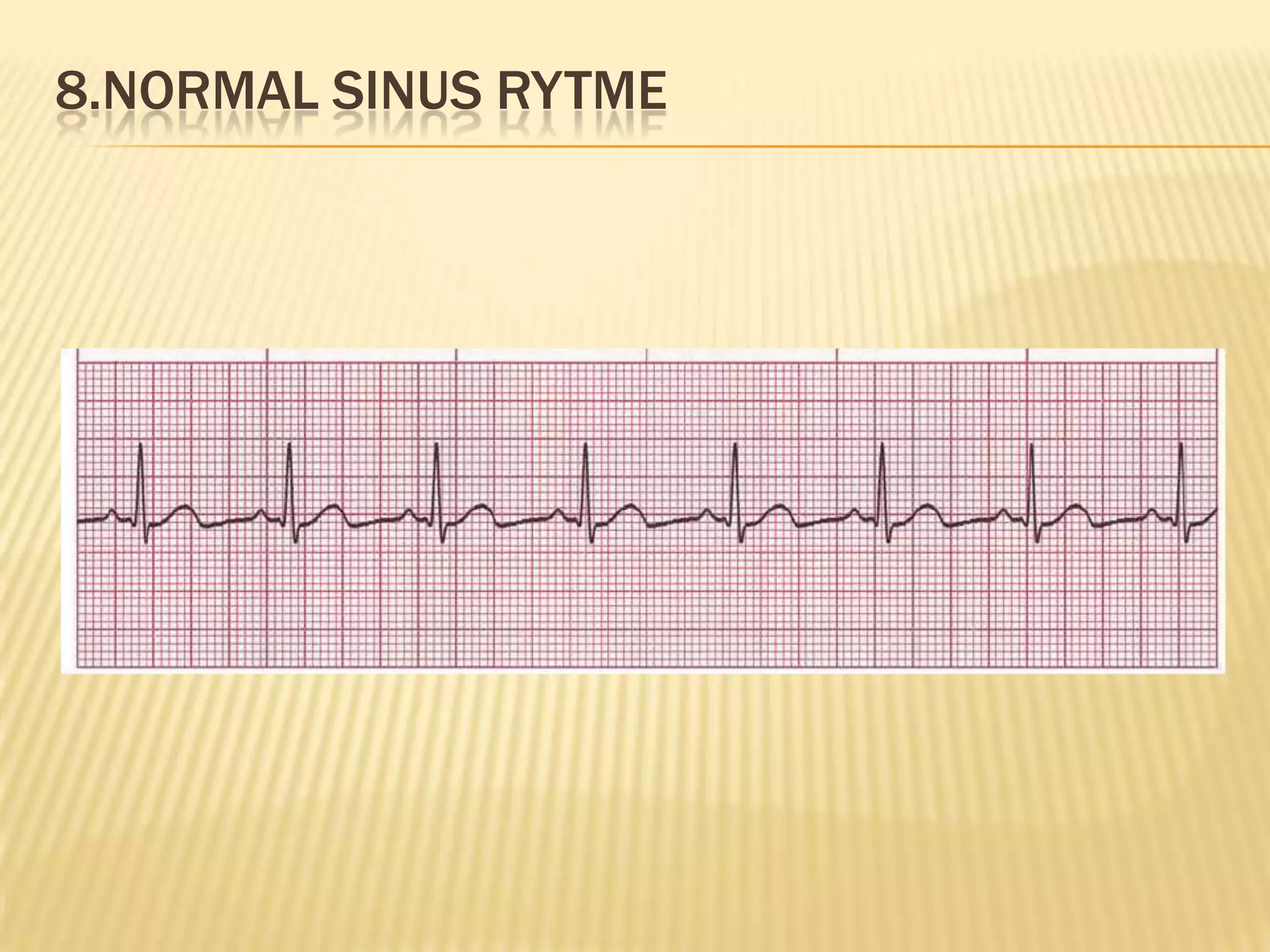 10 gambar ekg slide shere | PPTX