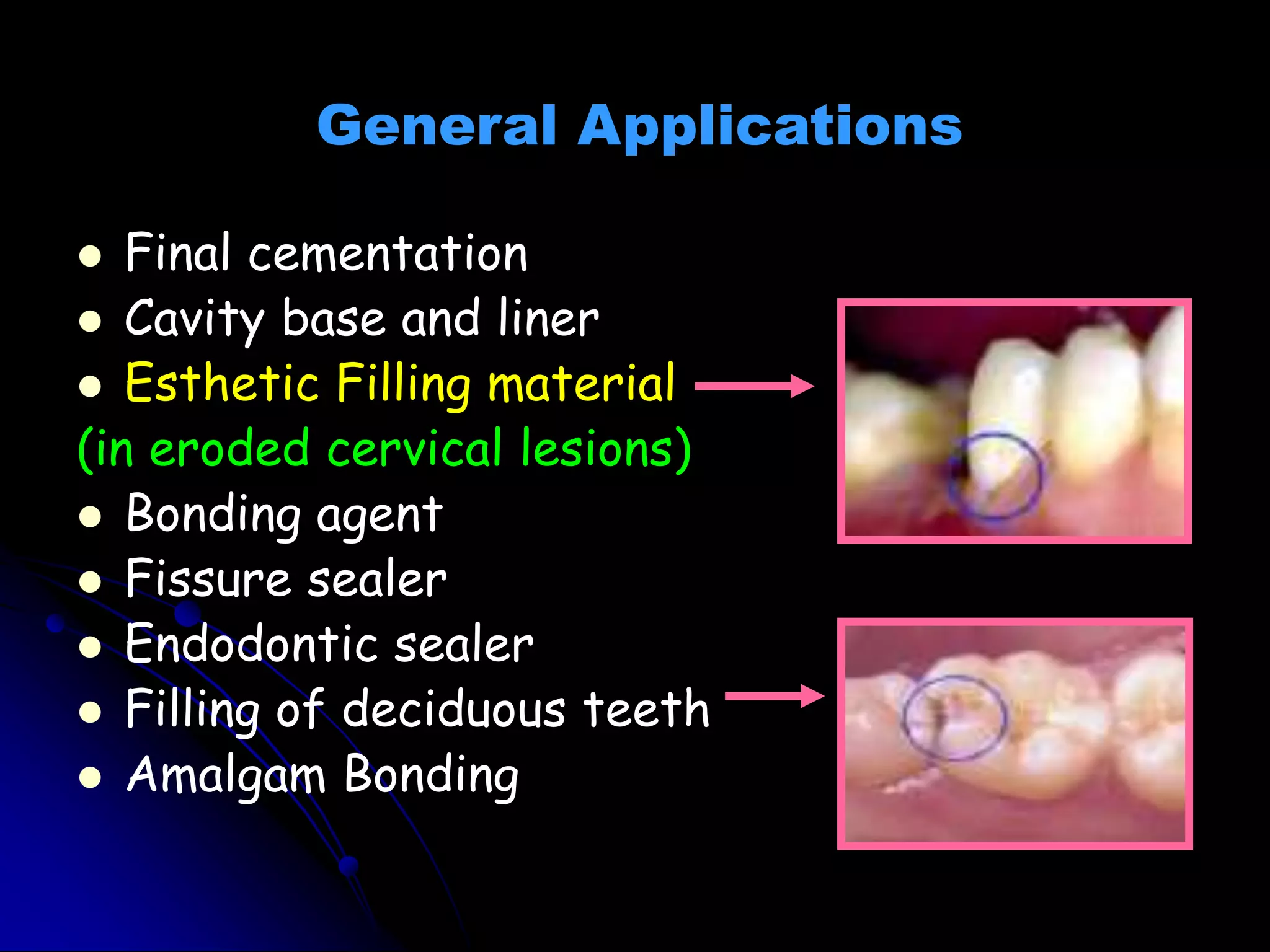 glass ionomer Metal-Modified GIC Resin-Modified GIC dental material | PPS