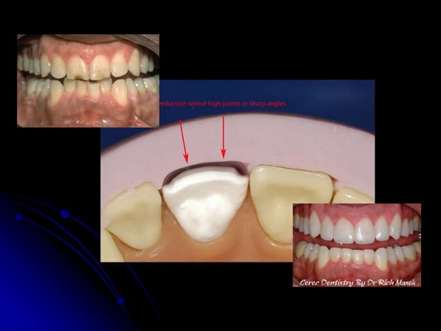 glass ionomer Metal-Modified GIC Resin-Modified GIC dental material | PPS