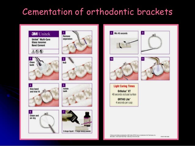 glass ionomer Metal-Modified GIC Resin-Modified GIC dental material