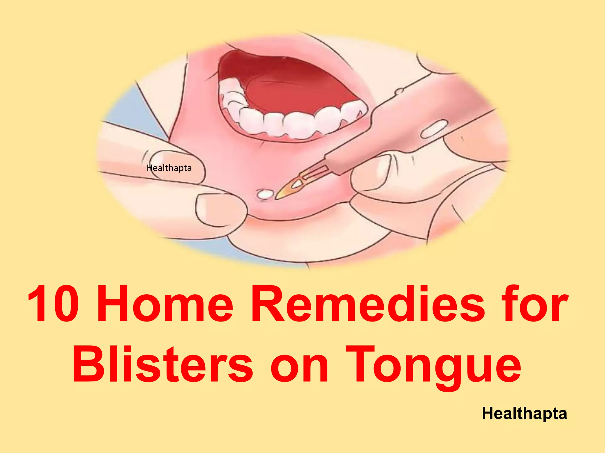 10 Home Remedies for Blisters on Tongue | PPTX | Ear, Nose and Throat Conditions | Diseases and ...