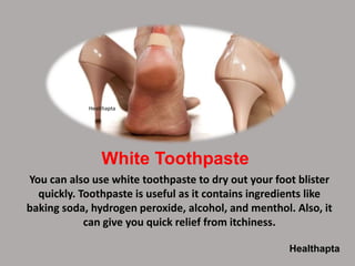 10 Home Remedies for Foot Blisters | PPT