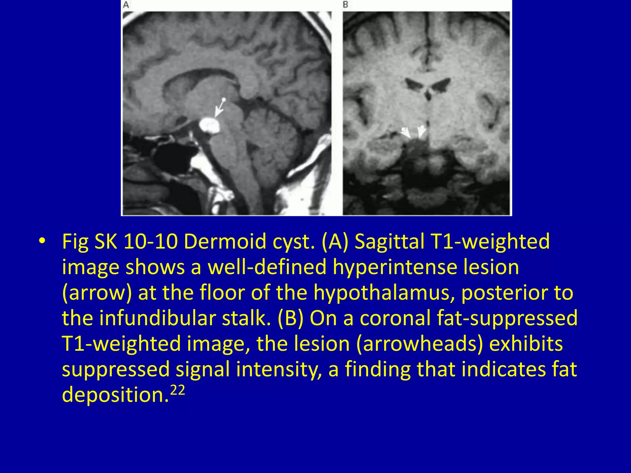 10 hypothalamic lesions on magnetic resonance imaging | PPTX