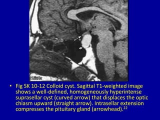 10 hypothalamic lesions on magnetic resonance imaging | PPTX