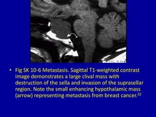 10 hypothalamic lesions on magnetic resonance imaging | PPTX