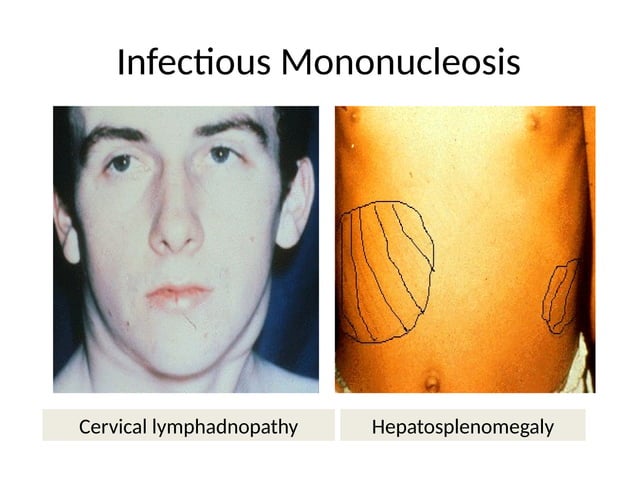 10 Infectious Mononucleosis 1 diagnosis.pptx