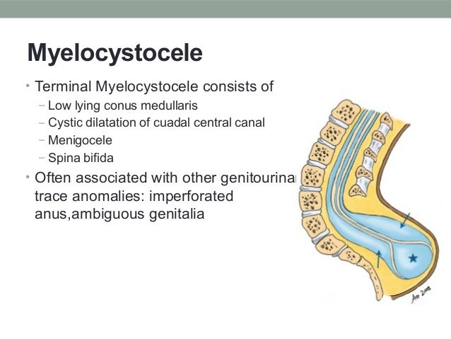 10 Interesting Myelocystocele Facts