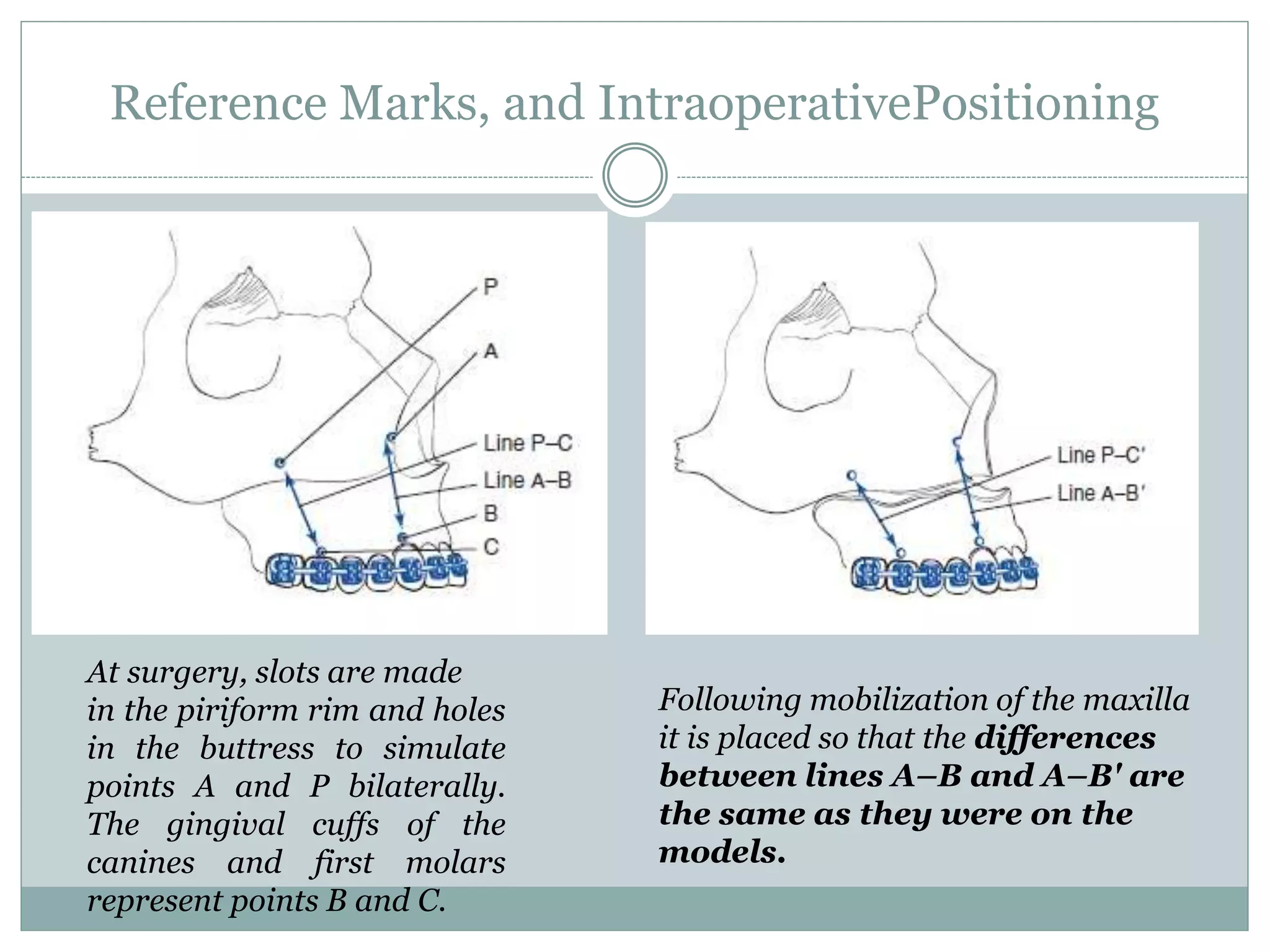 Maxillary Osteotomy Procedures | PPTX