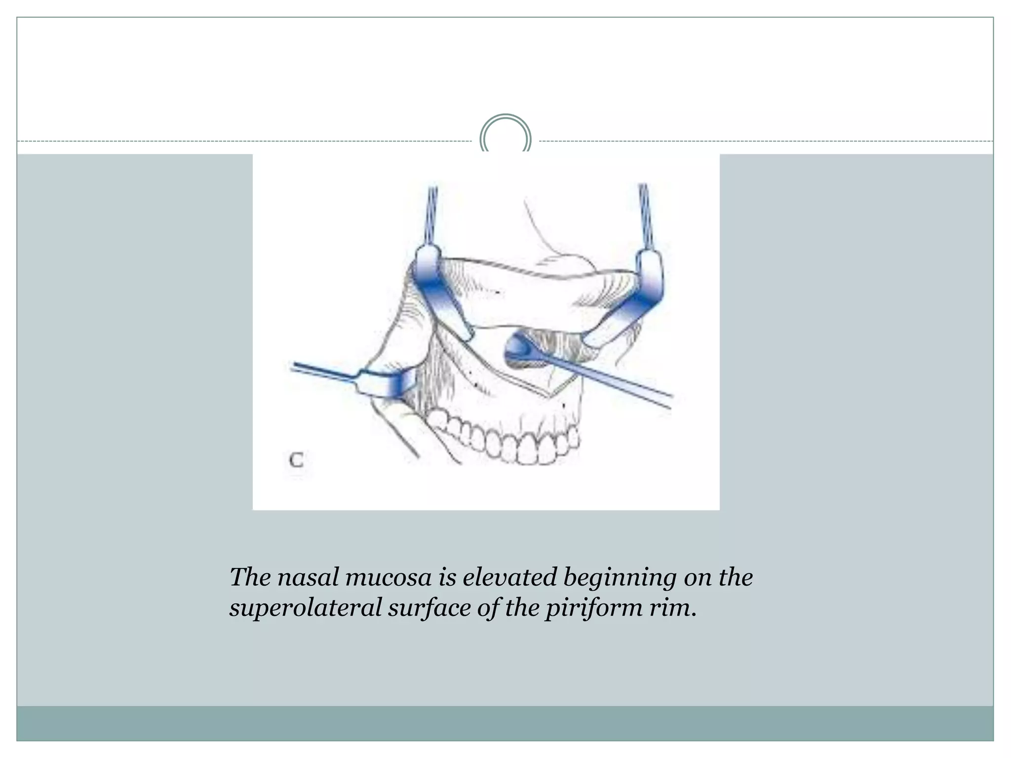 Maxillary Osteotomy Procedures | PPTX