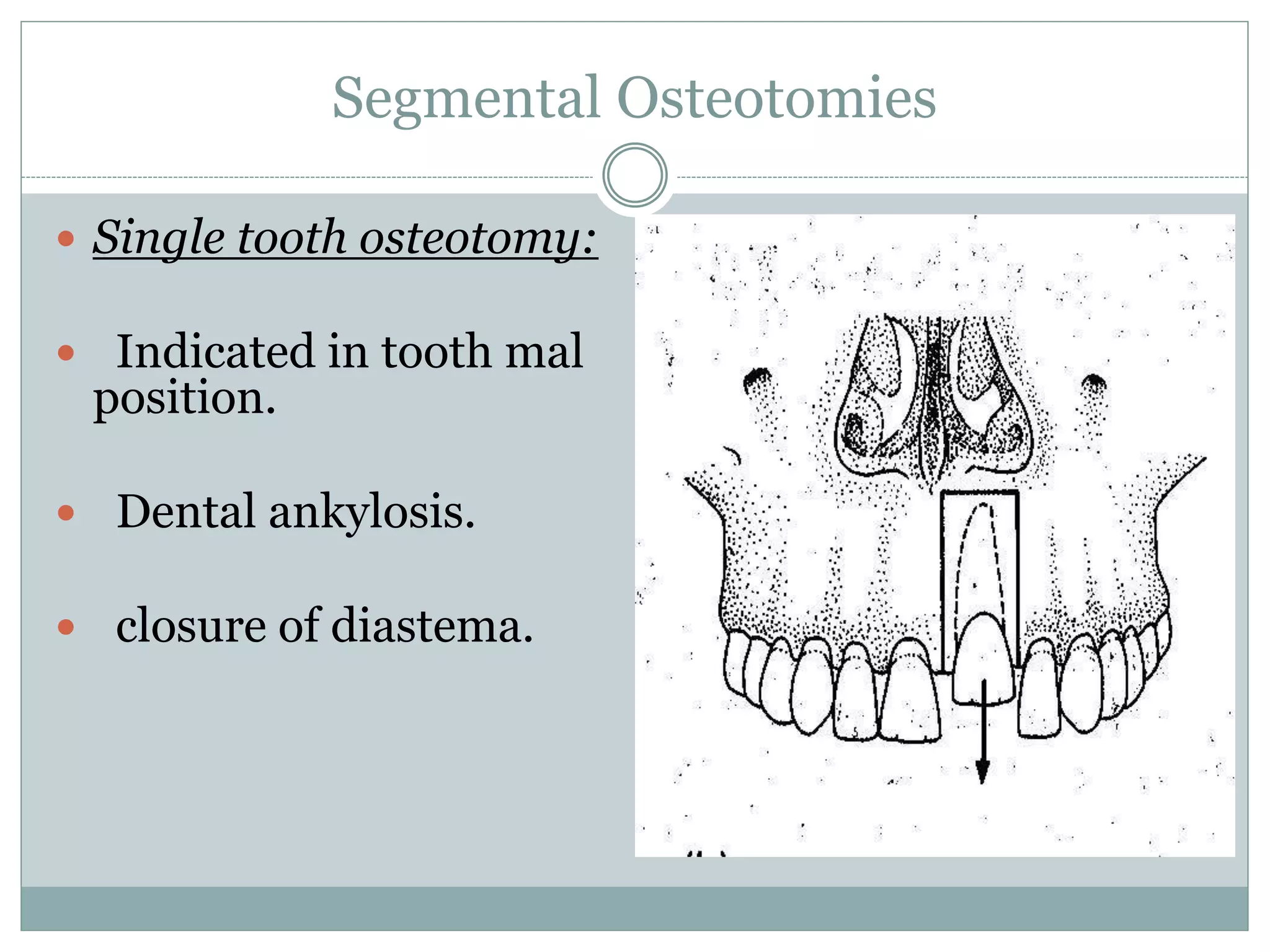 Maxillary Osteotomy Procedures | PPTX