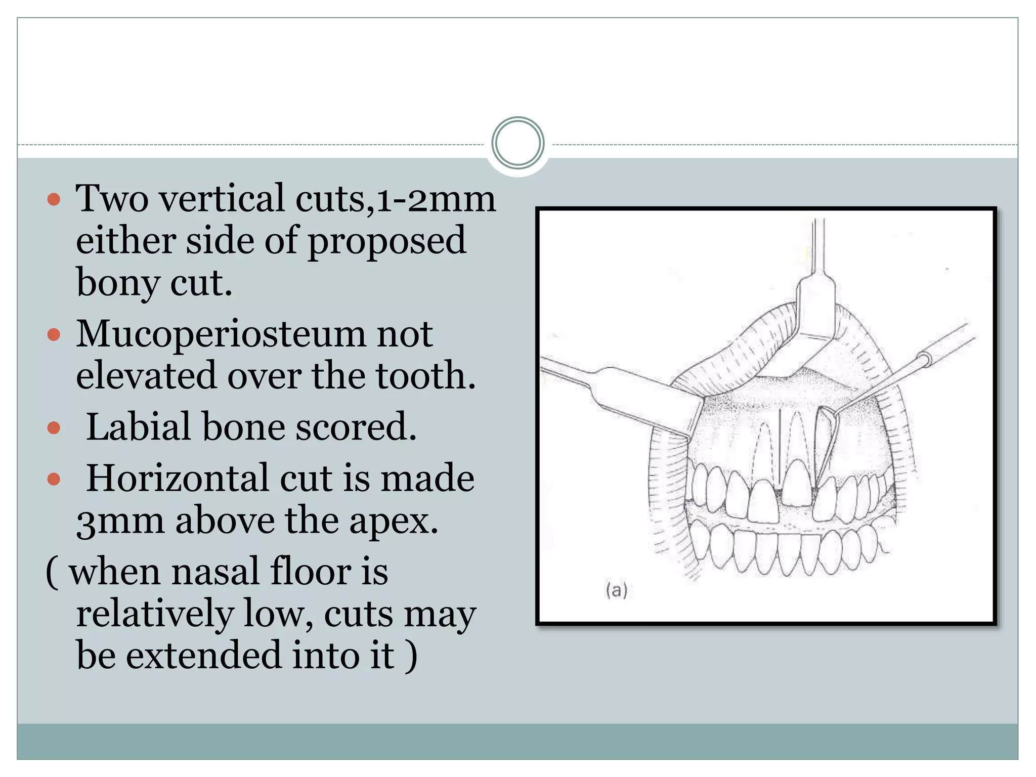 Maxillary Osteotomy Procedures | PPTX