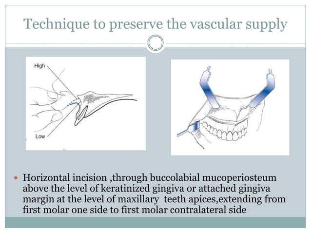 Maxillary Osteotomy Procedures | PPTX