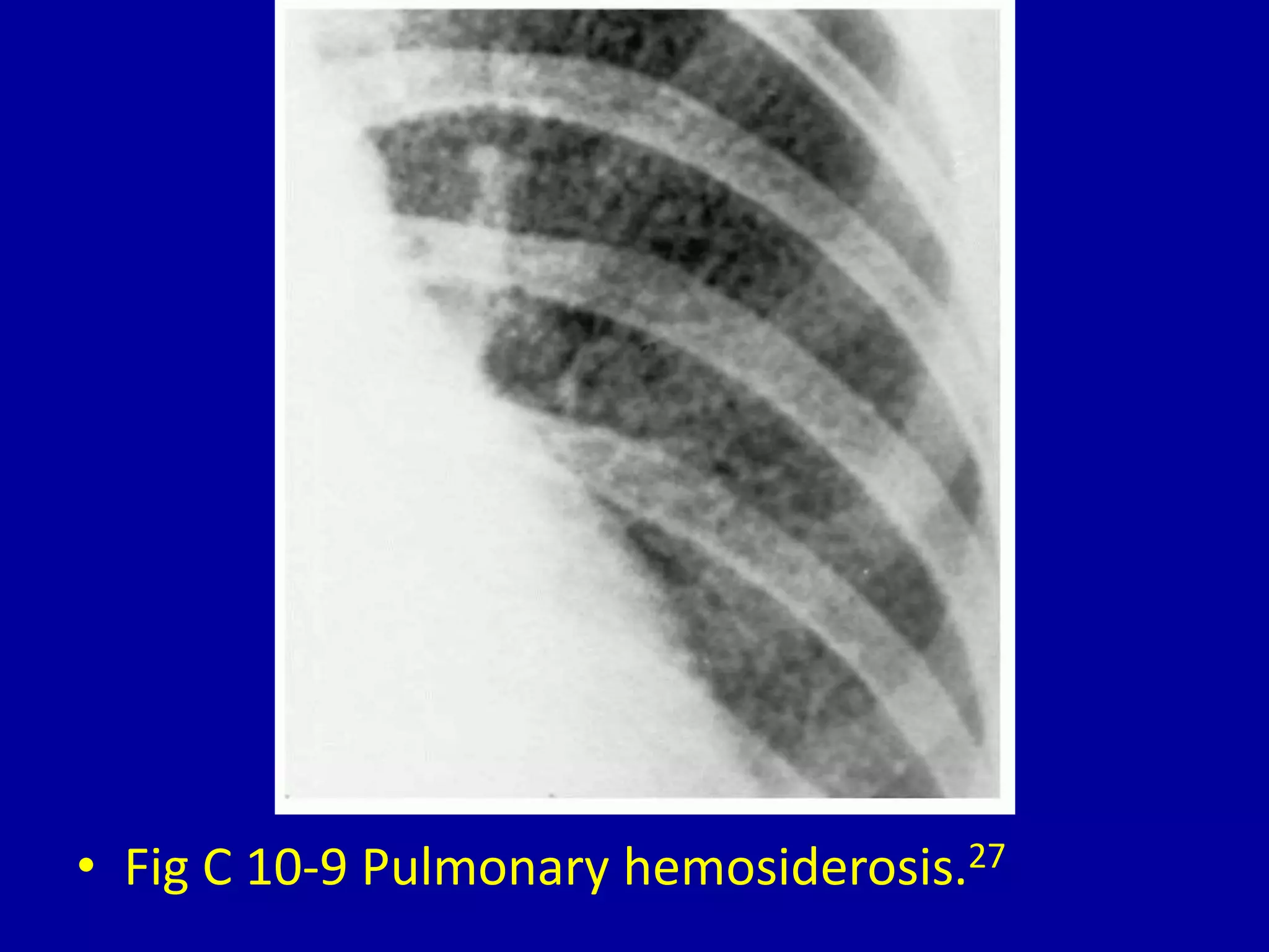 10 miliary nodules | PPT
