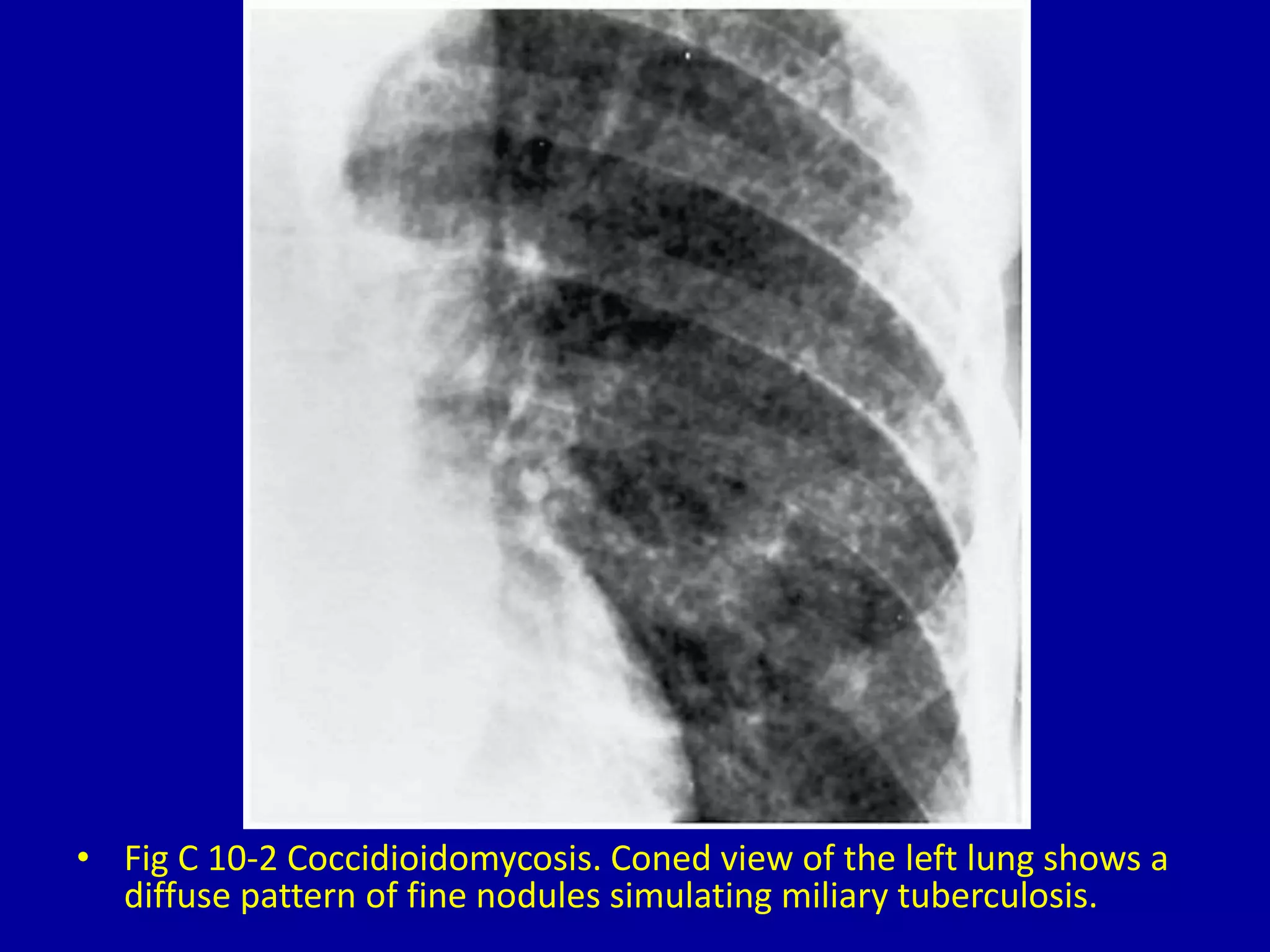 10 miliary nodules | PPT