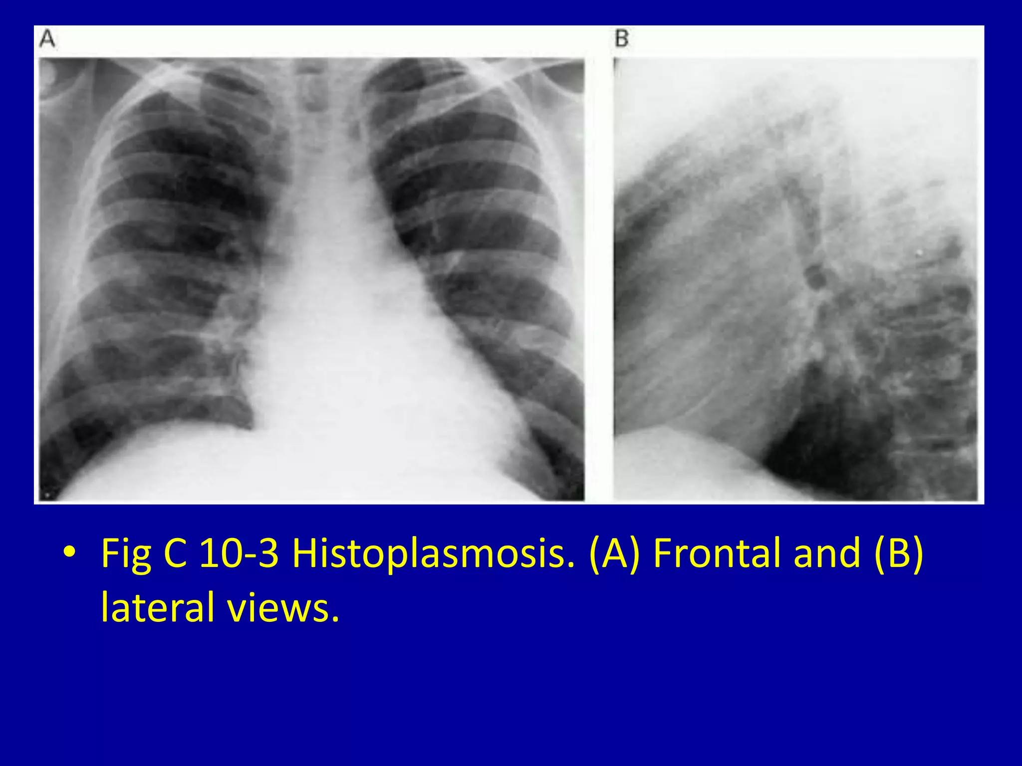 10 miliary nodules | PPT