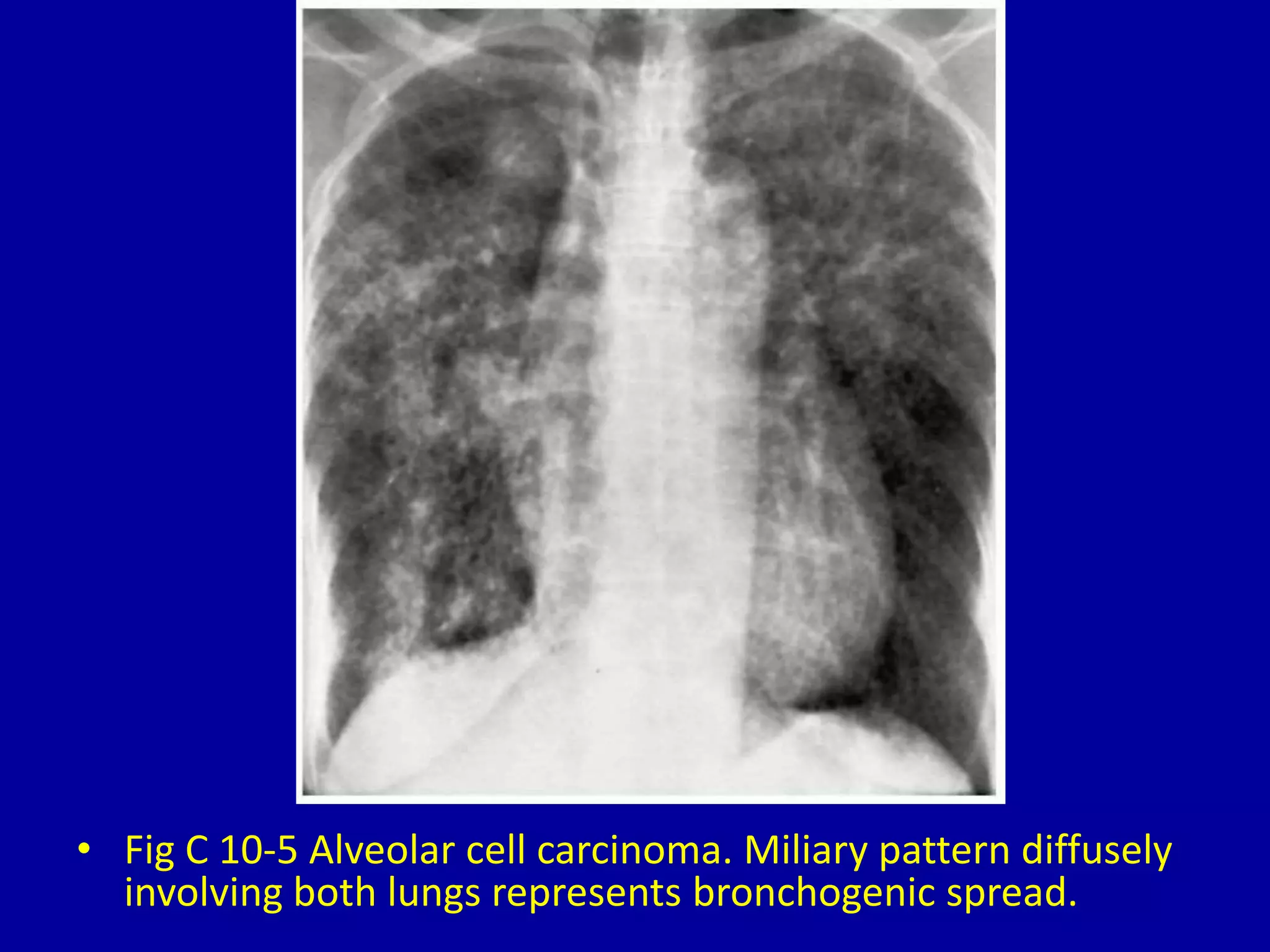 10 miliary nodules | PPT