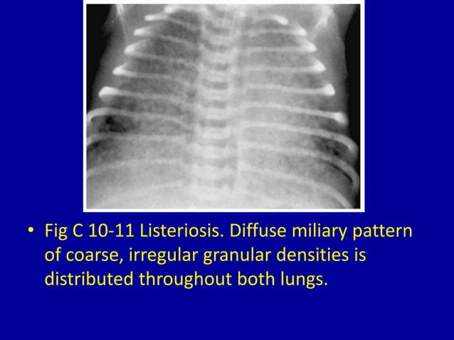 10 miliary nodules | PPT