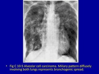 10 miliary nodules | PPT