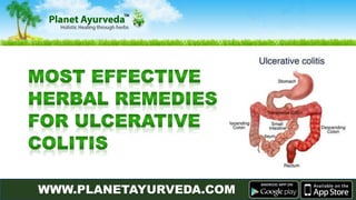 Natural Remedies For Colitis