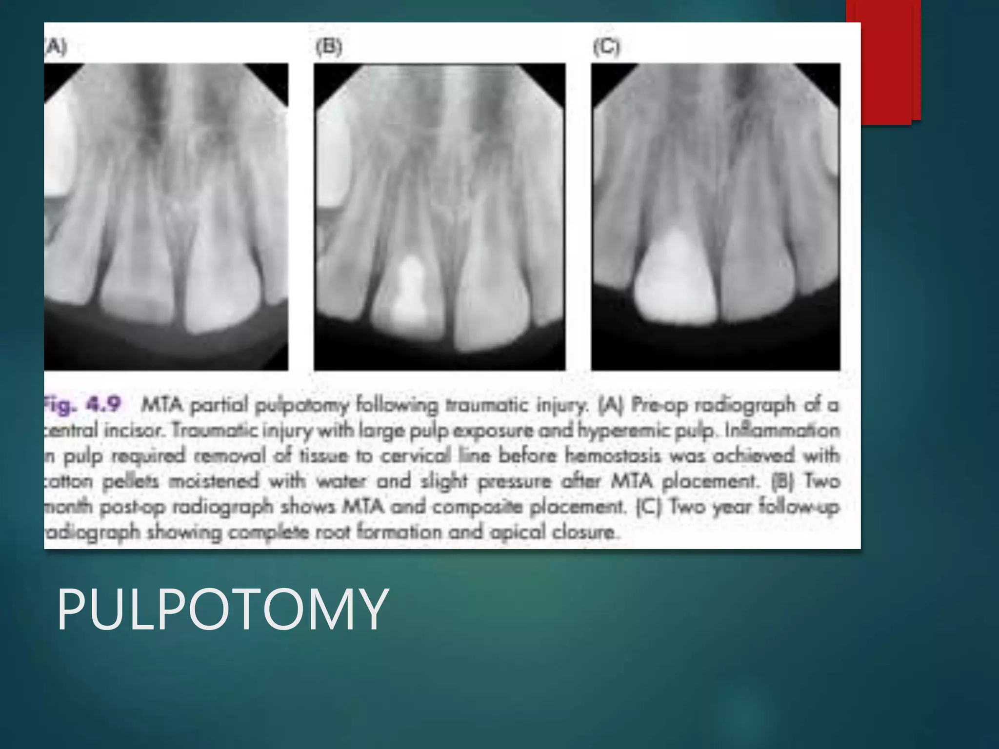 MTA and Biodentin | PPTX