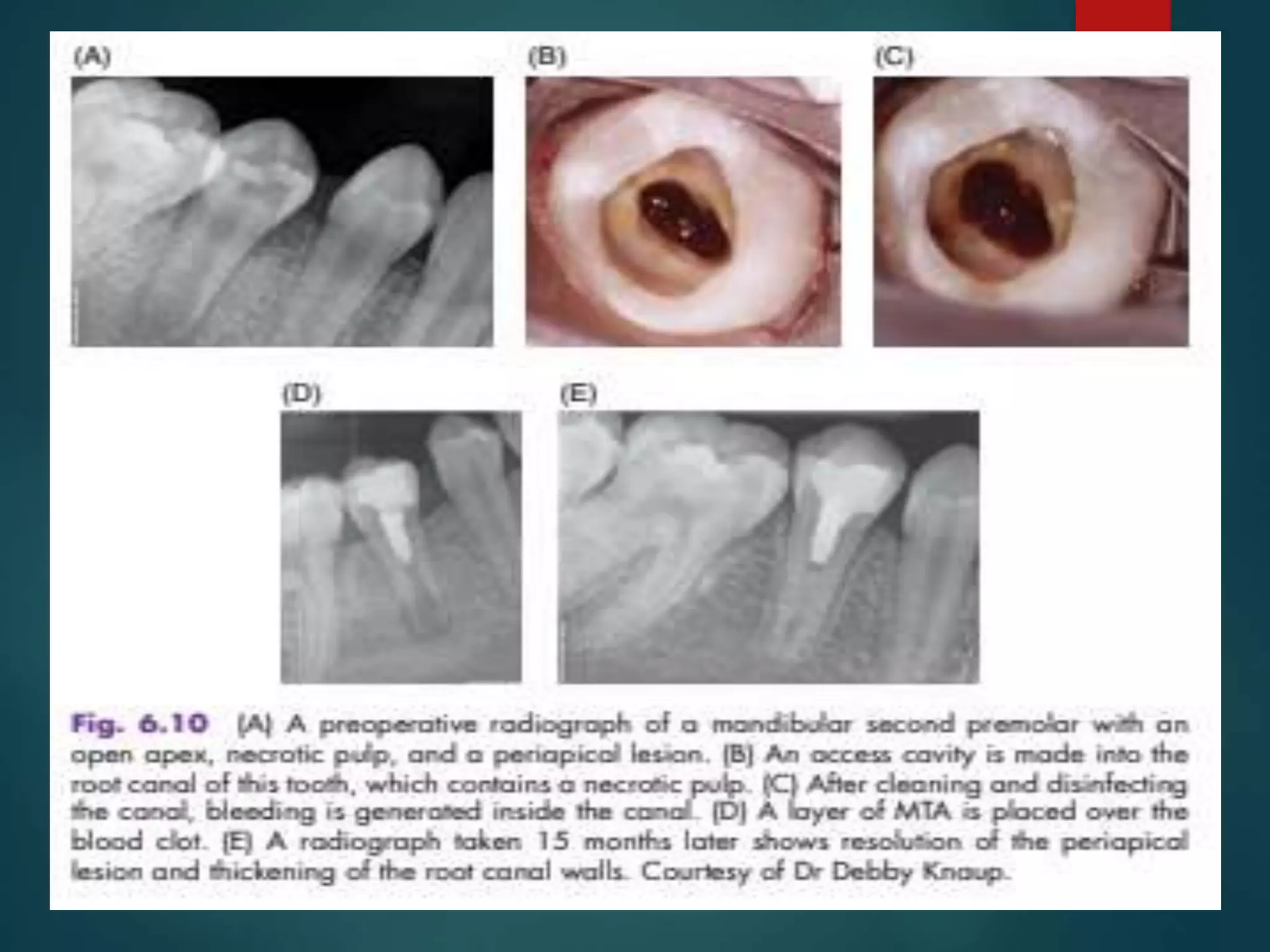 MTA and Biodentin | PPTX