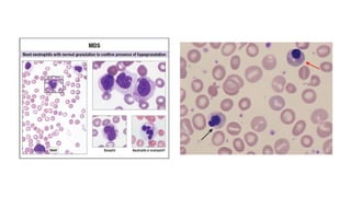 10 MYELODYSPLASTIC SYNDROME MIHS.pptx12355 | PPTX