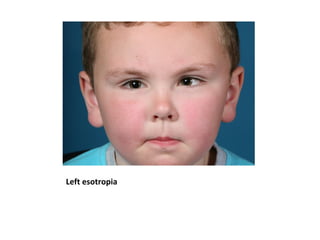 paediatric ophthalmology and strabismus | PPT