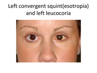 paediatric ophthalmology and strabismus | PPT