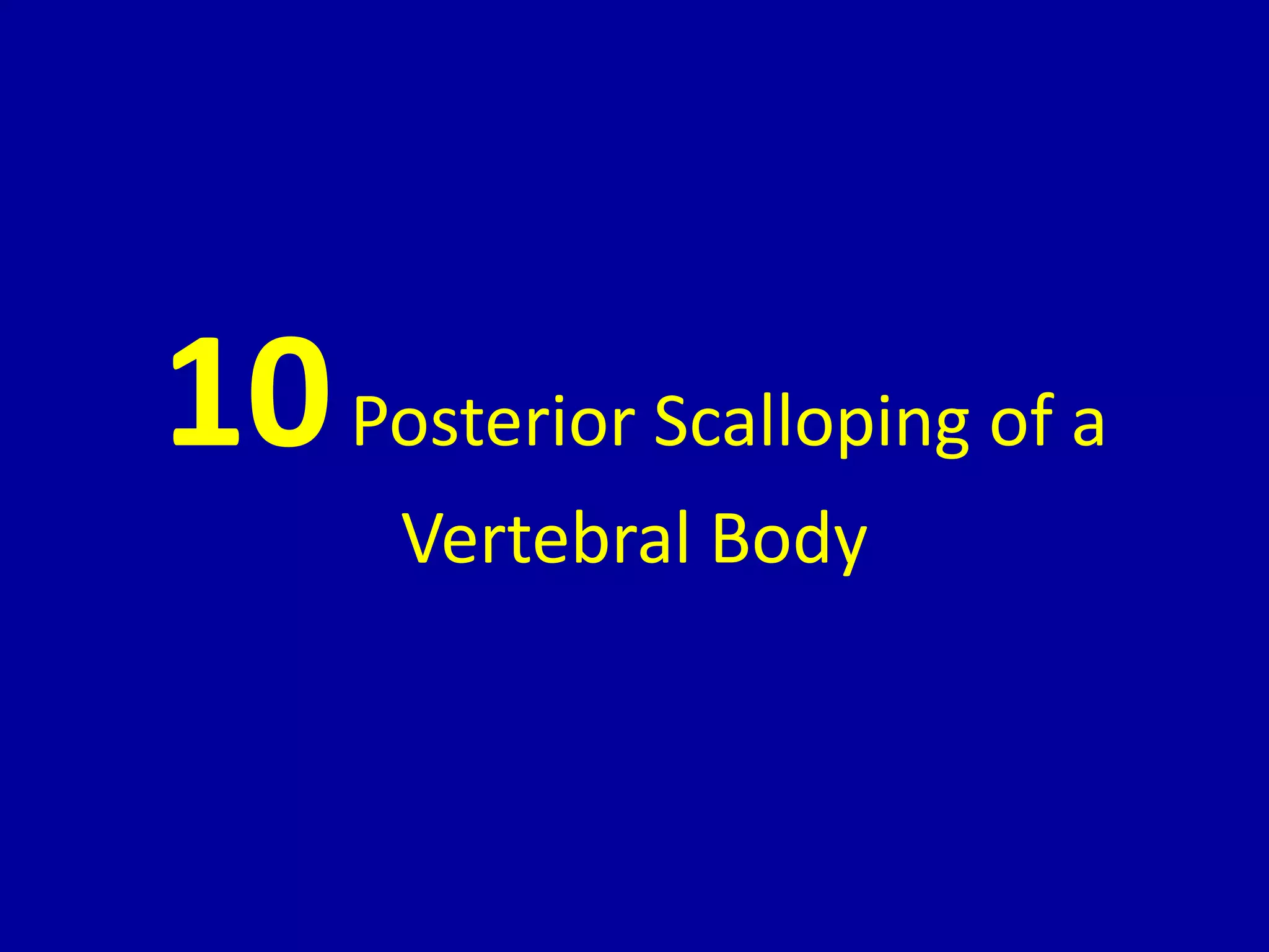 10 posterior scalloping of a vertebral body | PPTX