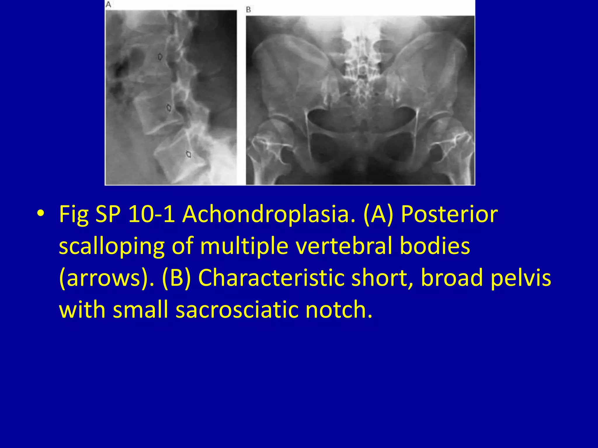 10 posterior scalloping of a vertebral body | PPTX