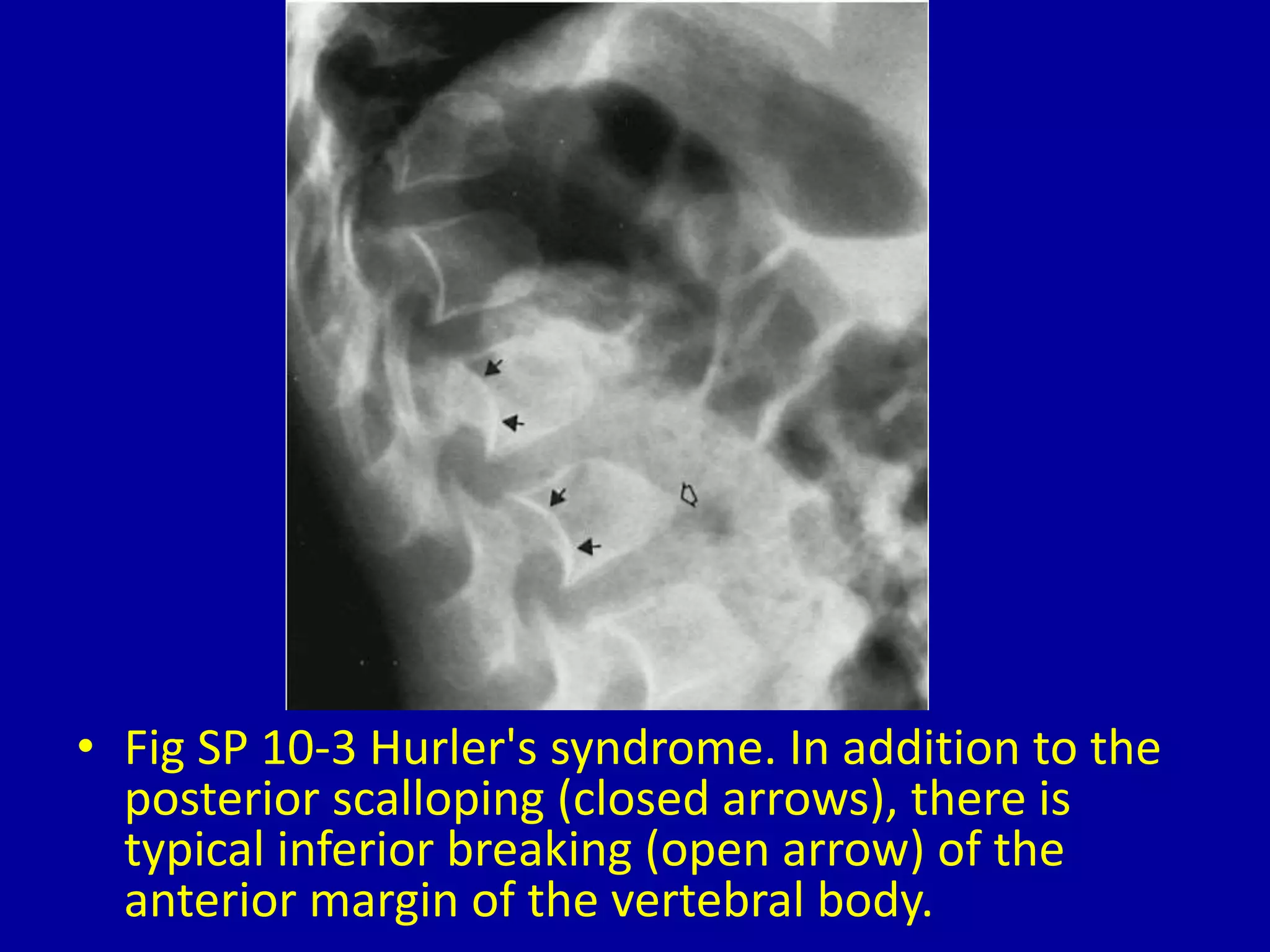 10 posterior scalloping of a vertebral body | PPTX