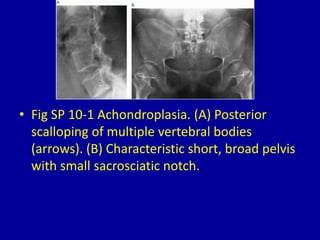 10 posterior scalloping of a vertebral body | PPT