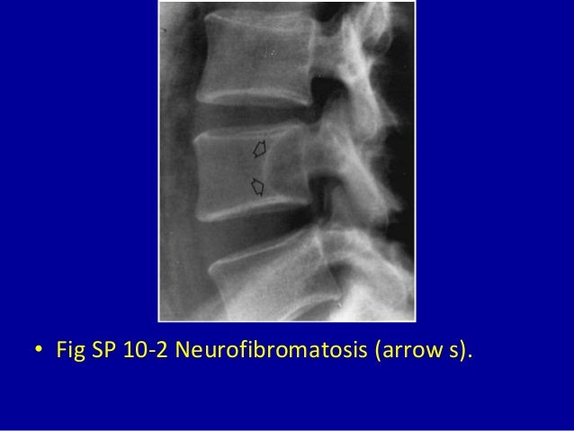 10 posterior scalloping of a vertebral body