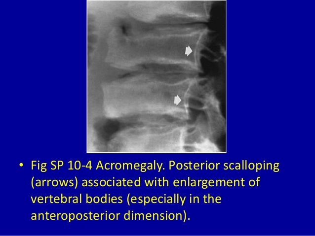 10 posterior scalloping of a vertebral body