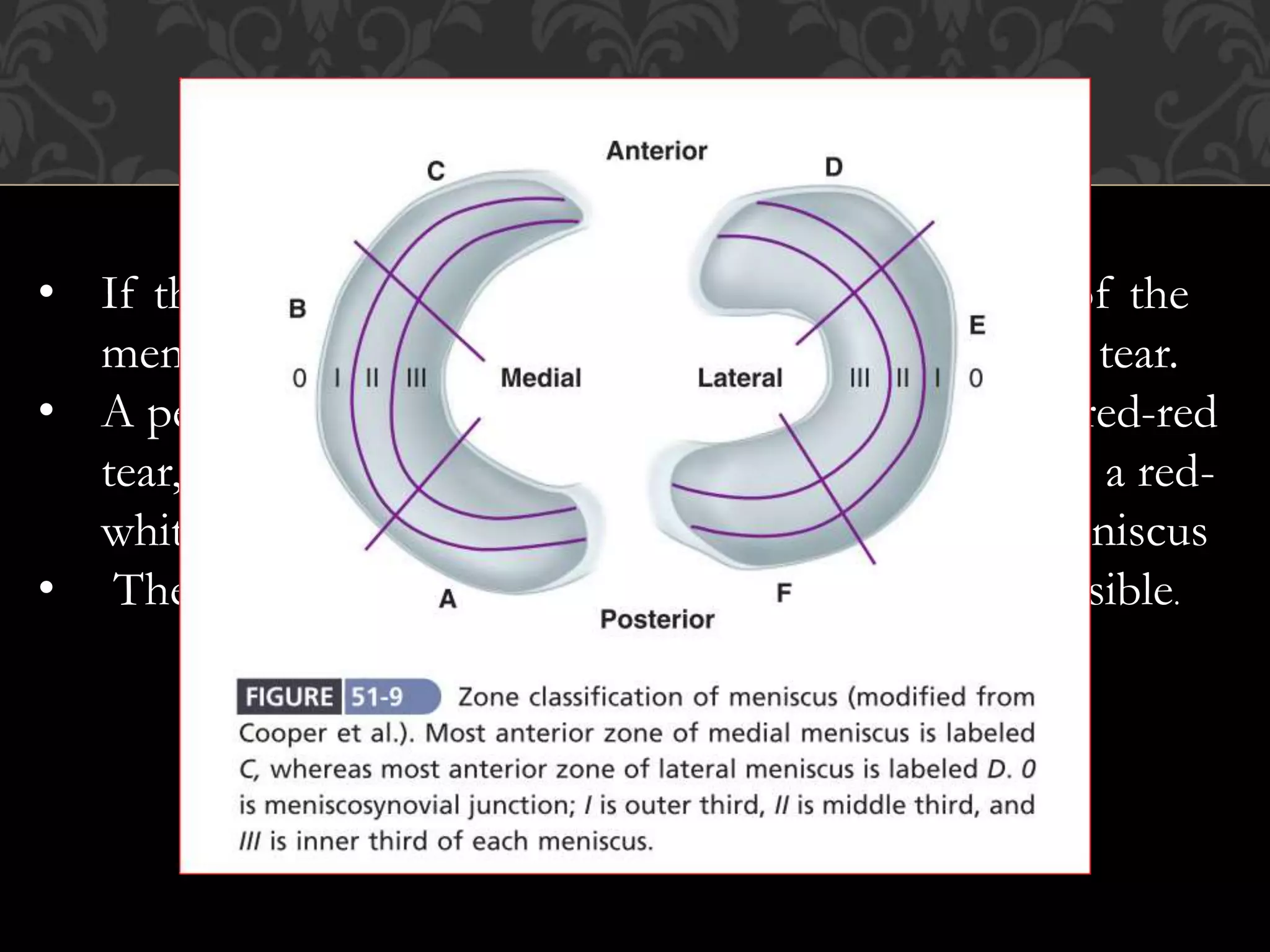 10 seminar arthroscopy of knee and meniscectomy | PPTX