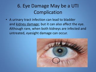 10 shocking facts about urinary tract infections | PPT