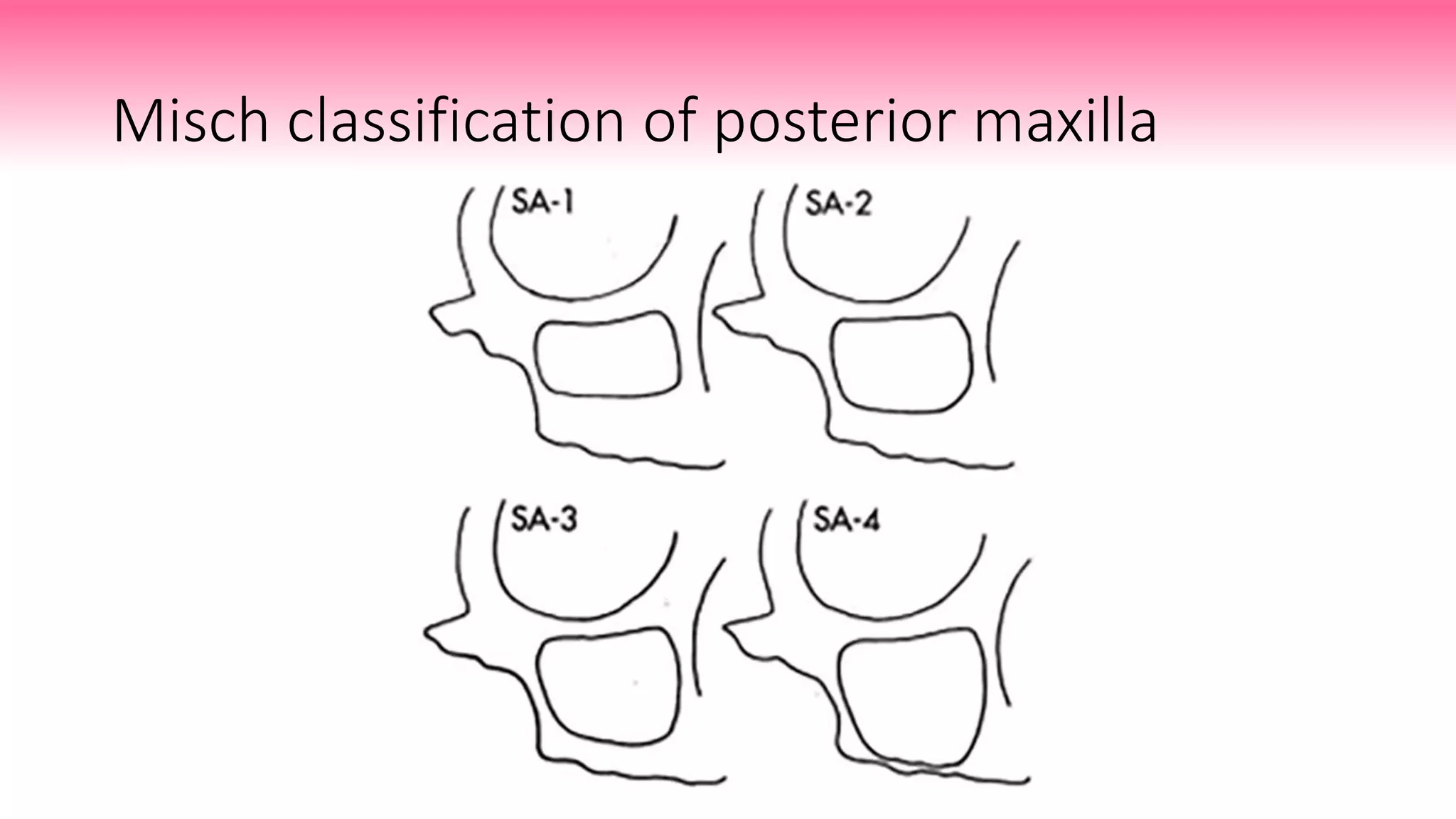 10 SINUS LIFT PROCEDURES seminar 10.pptx