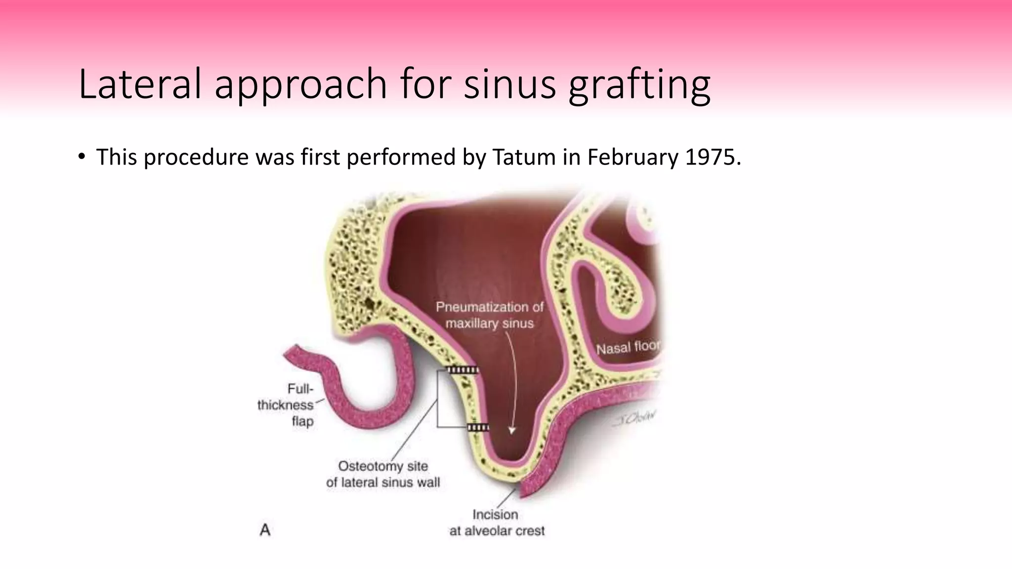 10 SINUS LIFT PROCEDURES seminar 10.pptx