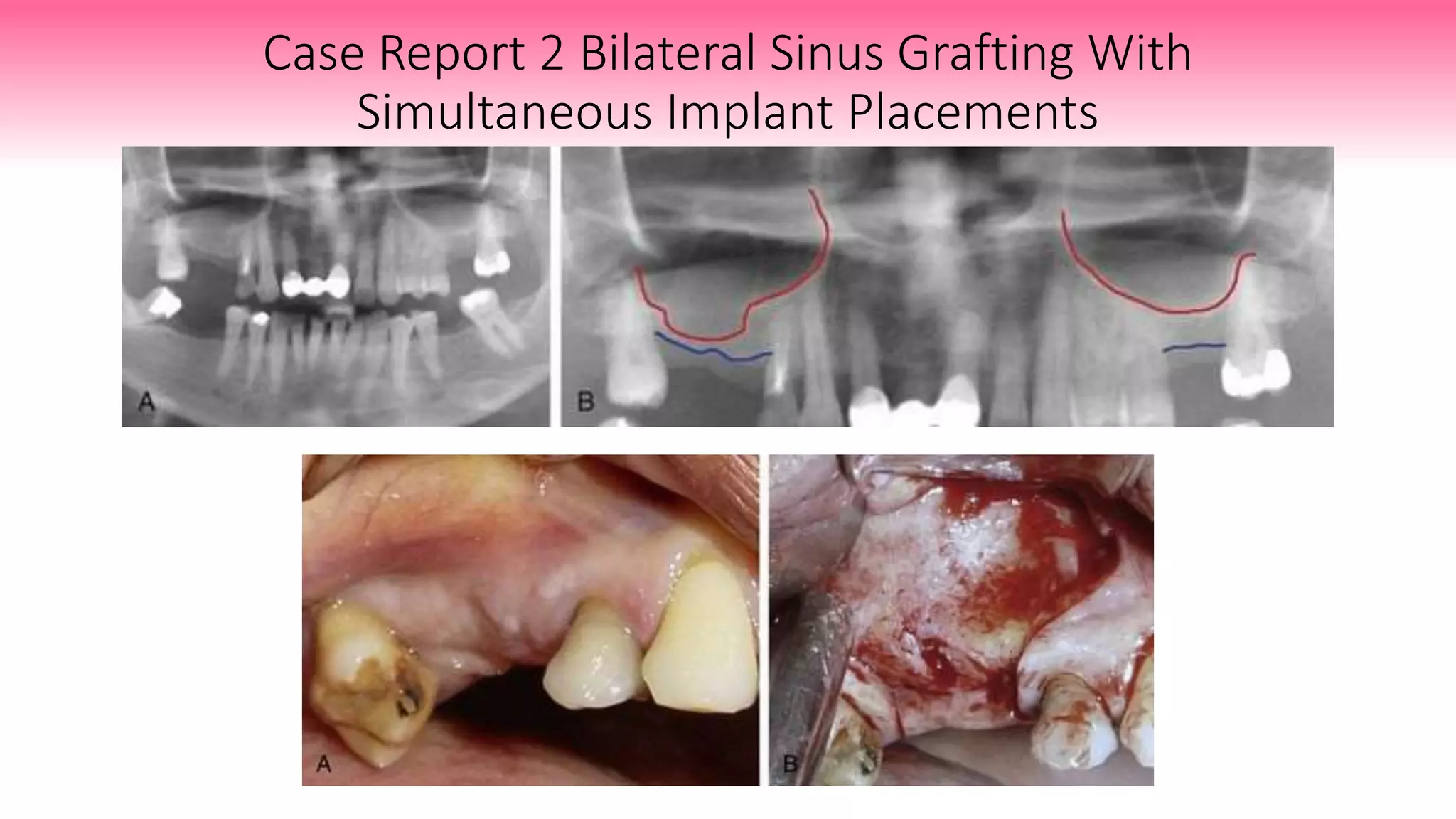 10 SINUS LIFT PROCEDURES seminar 10.pptx