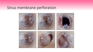 10 SINUS LIFT PROCEDURES seminar 10.pptx