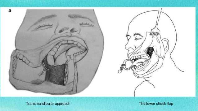 Dr Rahul VC Tiwari - Novel Transoral Approach to the Posterolateral M…