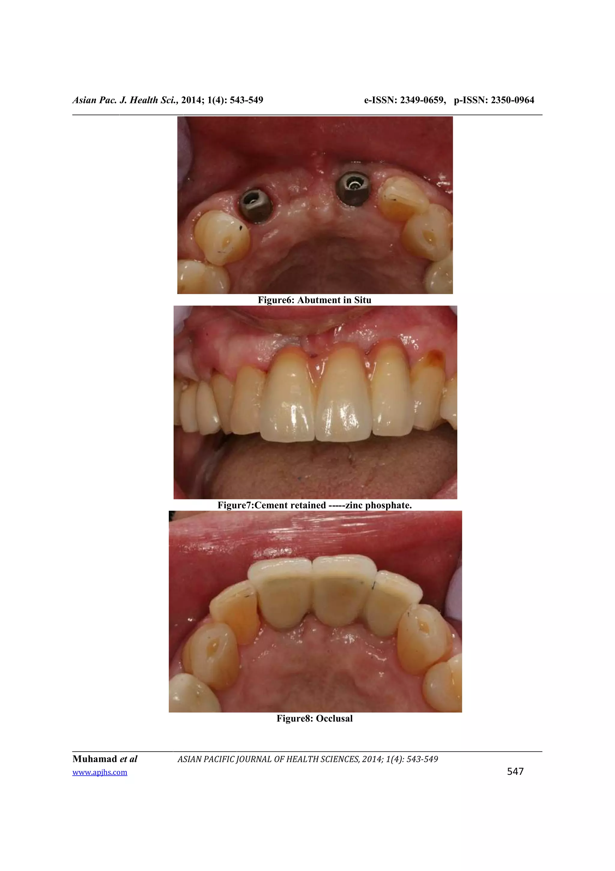 tooth extraction, immediate implant placement a case report | PDF