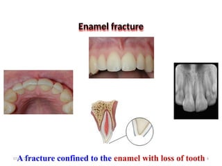 10)Trauma of tooth, soft tissue and jaws.pptx