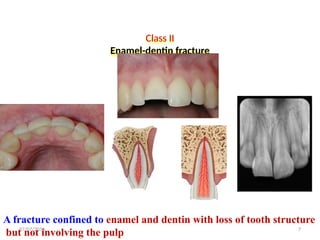 10)Trauma of tooth, soft tissue and jaws.pptx