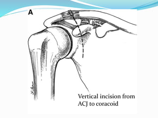 Anotomic-Biological Reconstruction of Acromio-Clavicular Joint Injuries ...