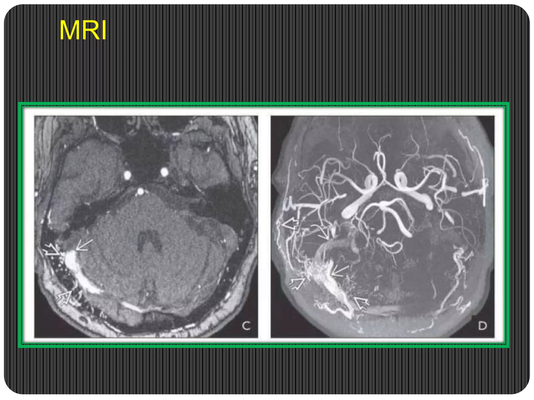 Vascular brain lesions for radiology by Dr Soumitra Halder | PPTX