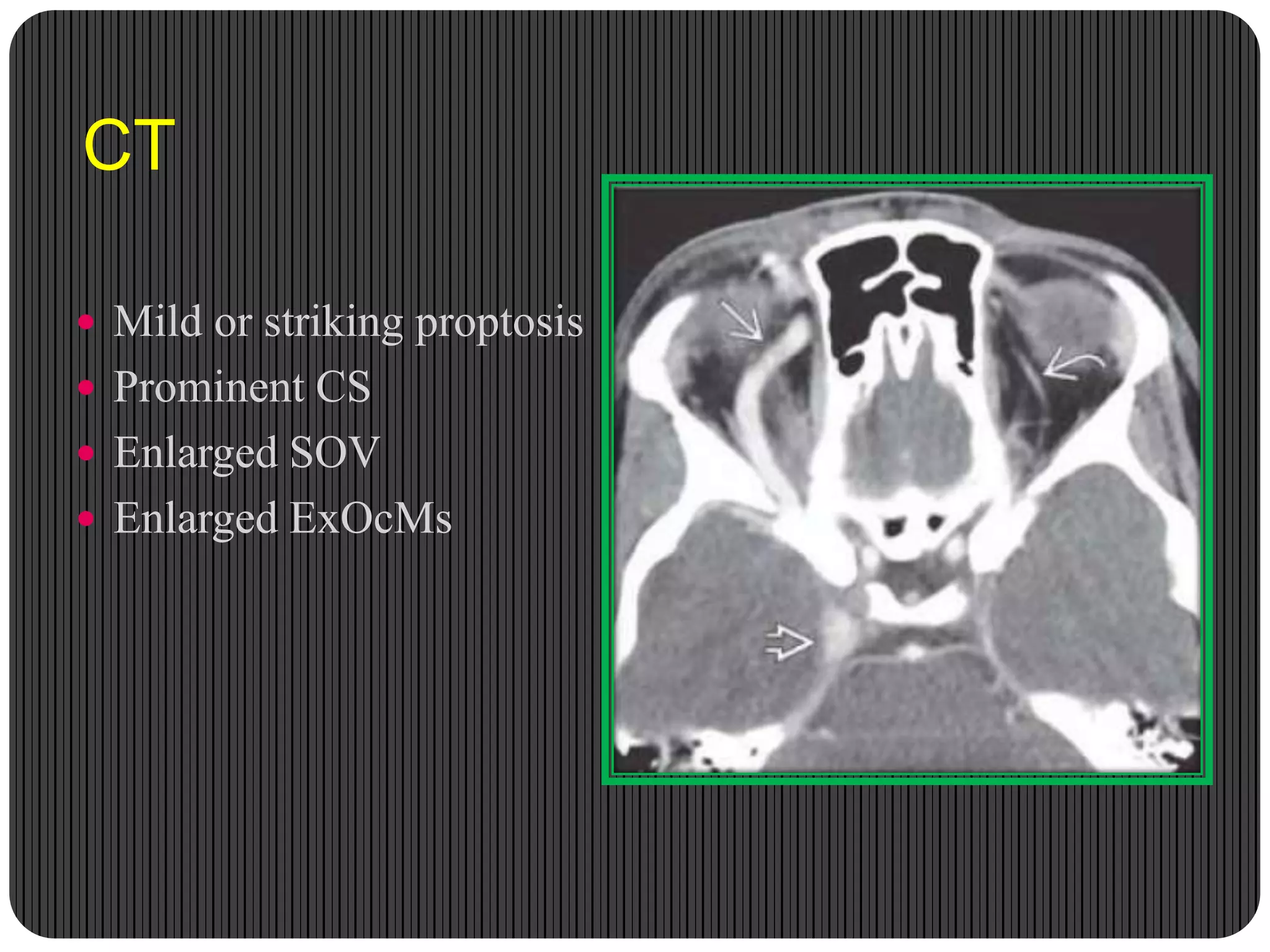Vascular brain lesions for radiology by Dr Soumitra Halder | PPTX